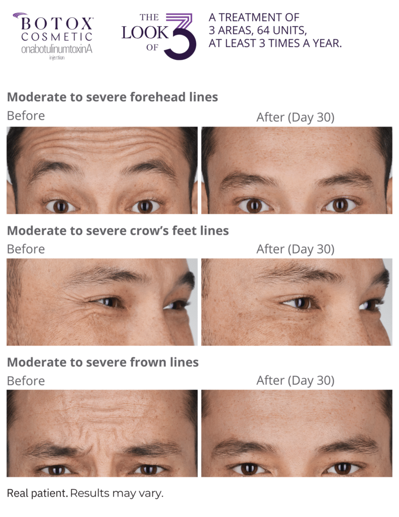 Botox Swansea IL - Botulinum Toxin Type A Swansea IL