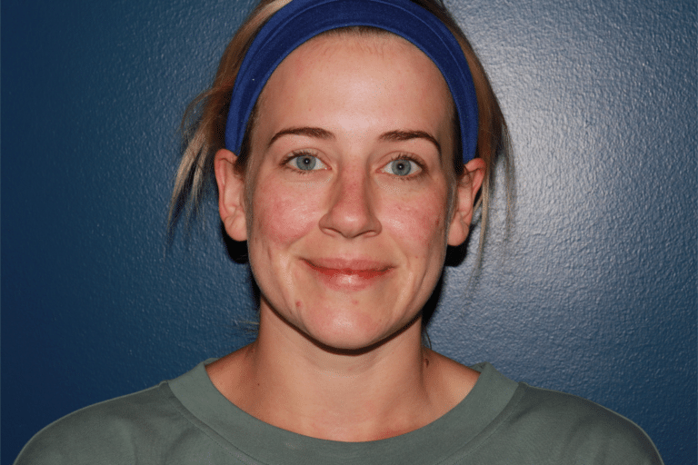 BBL Forever Clear - Microneedling Combination Treatment