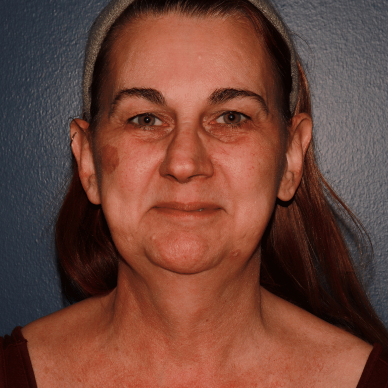 CO2 Fractional Laser Archives - Musick Dermatology & Advanced Clinical Spa