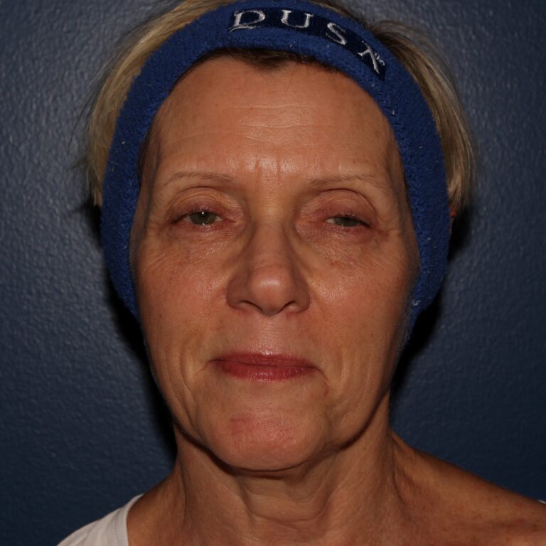 Broadband Light Archives Swansea IL - Musick Dermatology