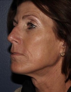 Secret RF Microneedling - Musick Dermatology & Advanced Clinic