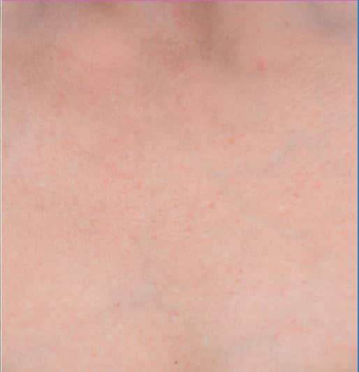 BBL HERO - Case: 6519 - Musick Dermatology & Advanced Clinical Spa