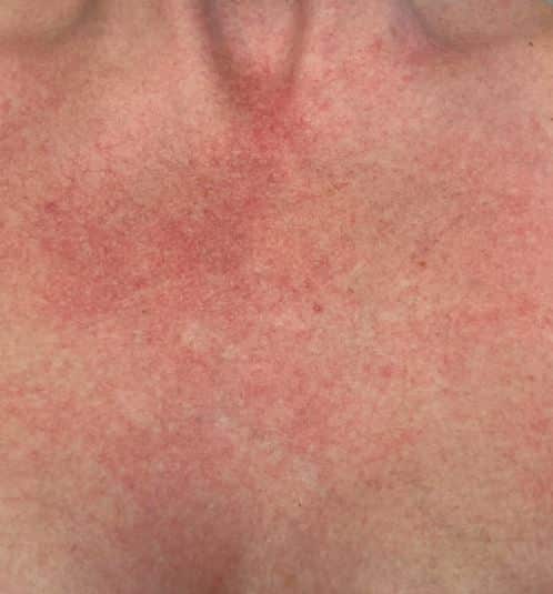 BBL HERO - Case: 6519 - Musick Dermatology & Advanced Clinical Spa