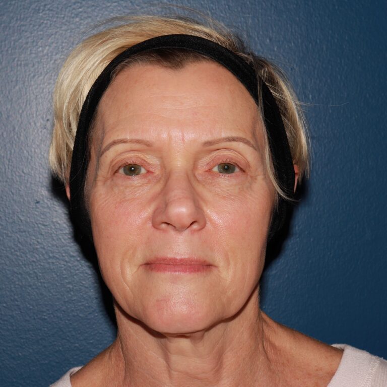 BBL Forever Young - Case: 6525 - Musick Dermatology & Advanced Clinical Spa