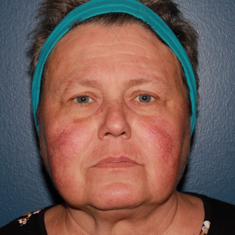 Broadband Light Archives Swansea IL - Musick Dermatology