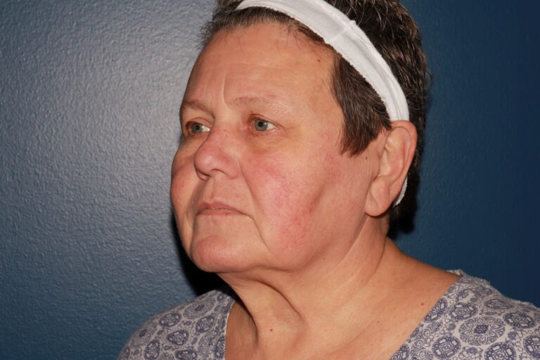 BBL - Red Vessels - Case: 6532 - Musick Dermatology & Advanced Clinical Spa