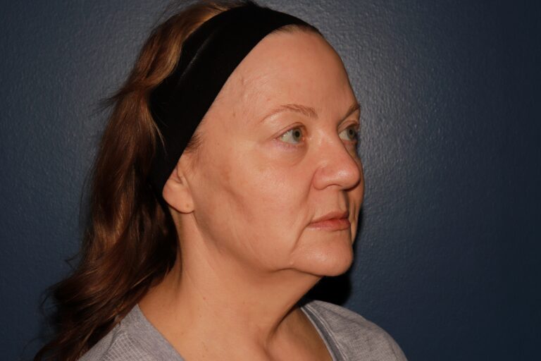 BBL Forever Young - Case: 6539 - Musick Dermatology & Advanced Clinical Spa