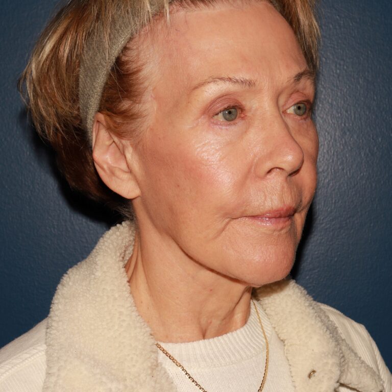 CO2 Fractional Laser Archives - Musick Dermatology & Advanced Clinical Spa