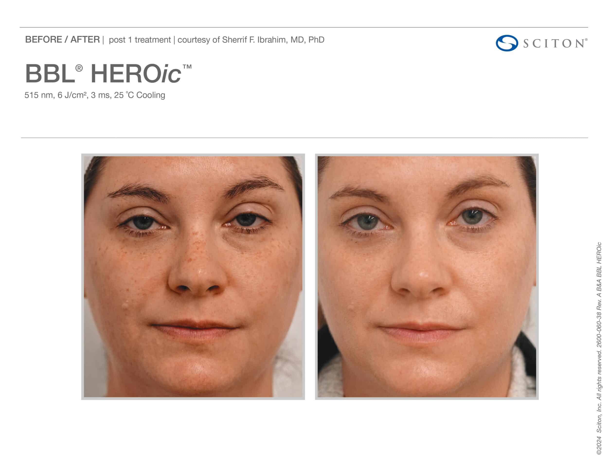 BBL Broadband Light Swansea IL - BBL Treatment St. Louis